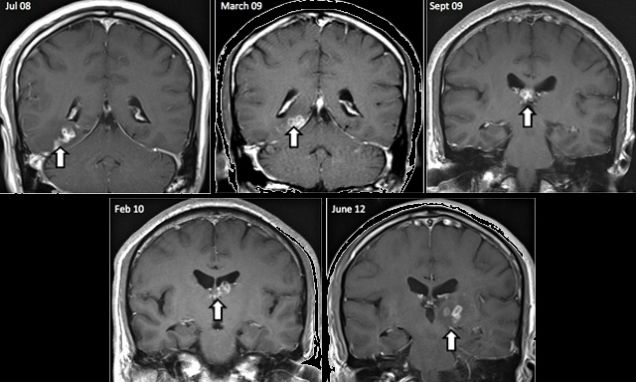 Man experiencing headaches, seizures, memory flashbacks and strange ...